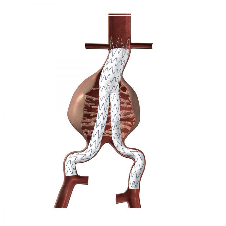 Verwijding van de slagaders - Vaatcentrum Antwerpen