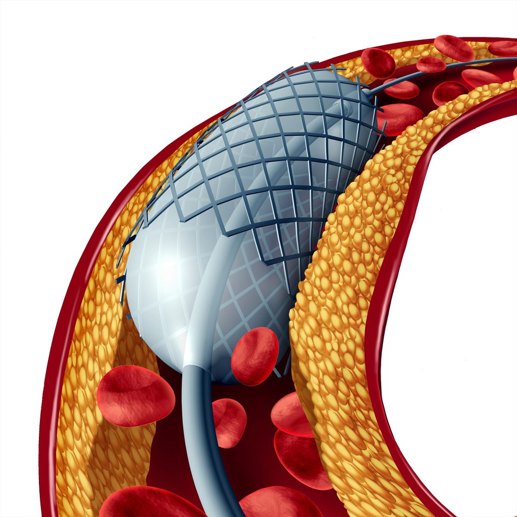 Verstopping van de slagaders in darm of nieren - Vaatcentrum Antwerpen