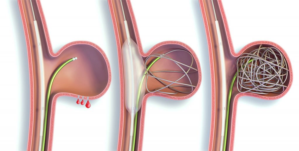 Bloeding van de slagaders - Vaatcentrum Antwerpen
